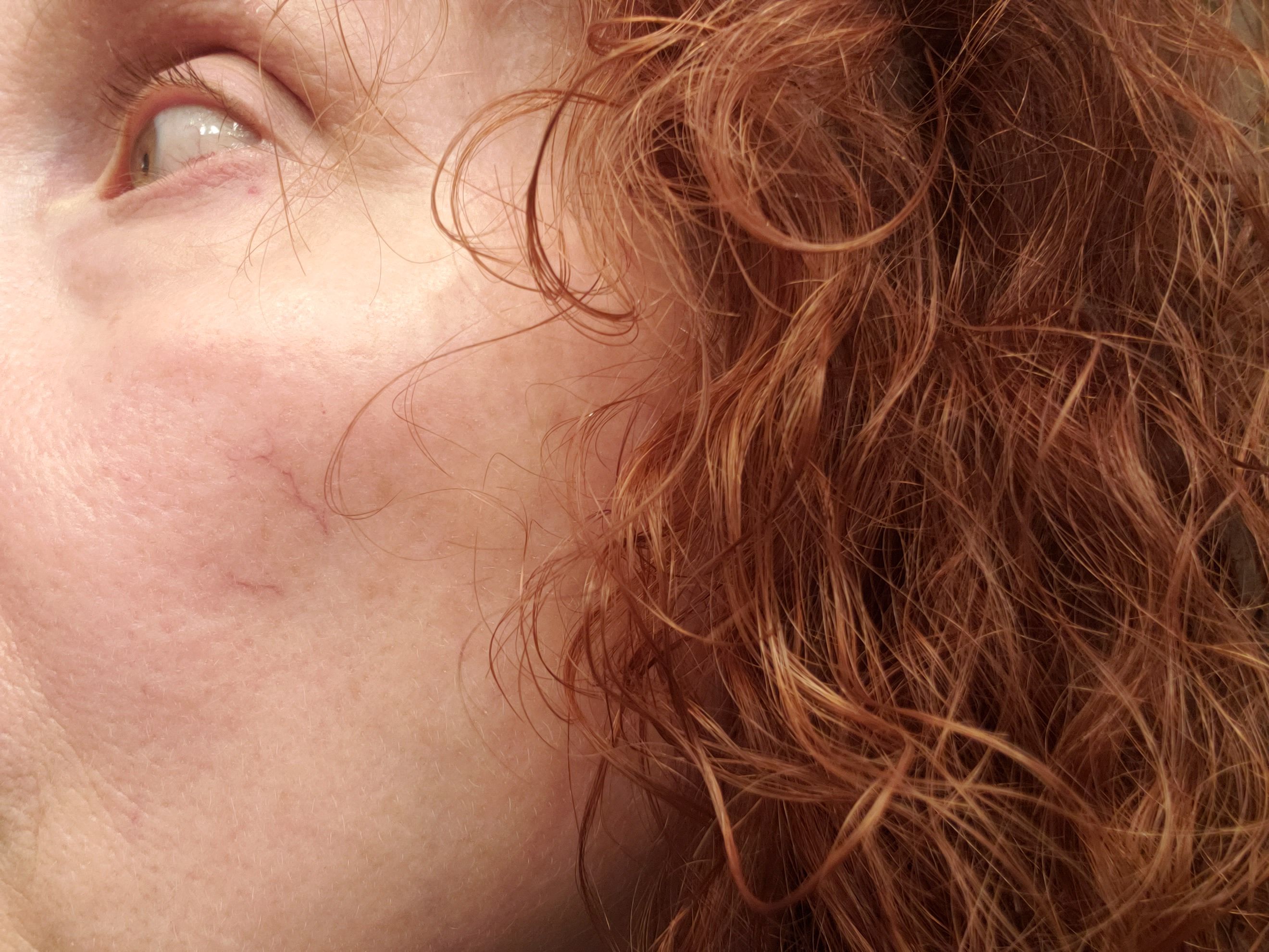 RLT Question - re broken capillaries on face - Page 3 - Blogs & Forums